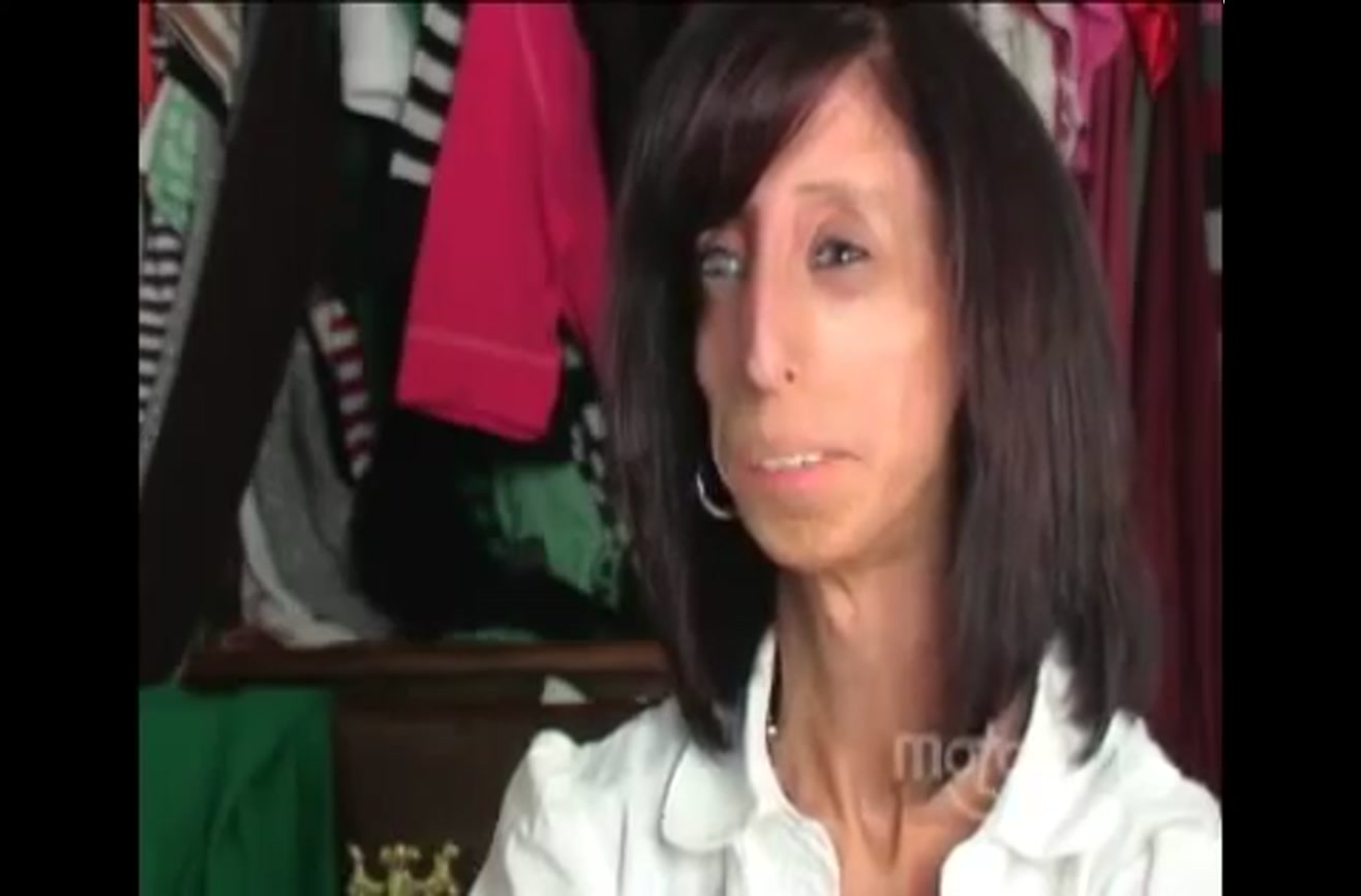 Woman with rare disease speaks out on bullying.