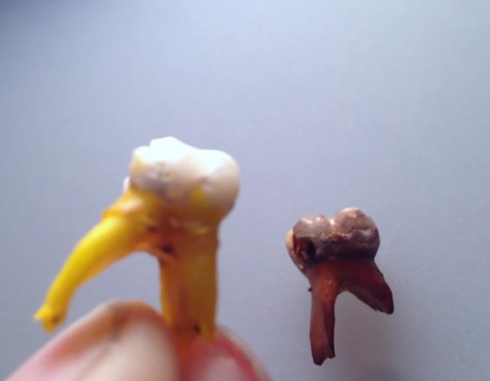 Why Mountain Dew is worse for your teeth than Coca-Cola.