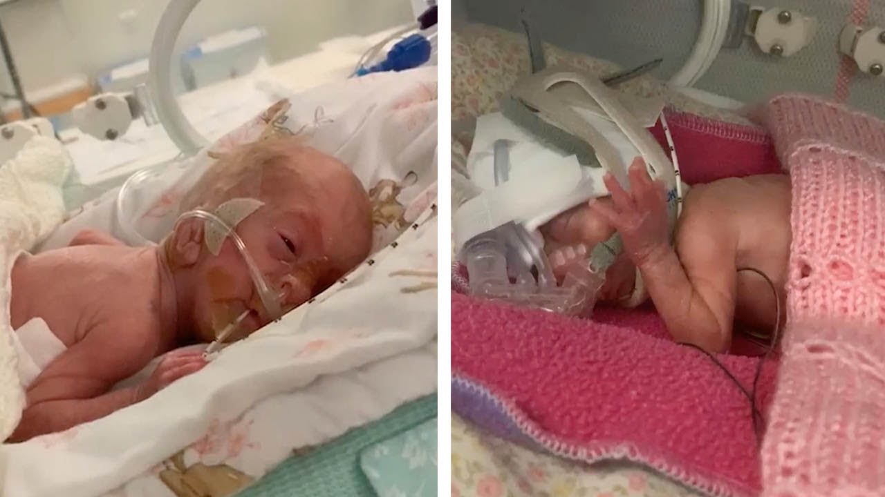 Miracle baby born smaller than her dad's hand.